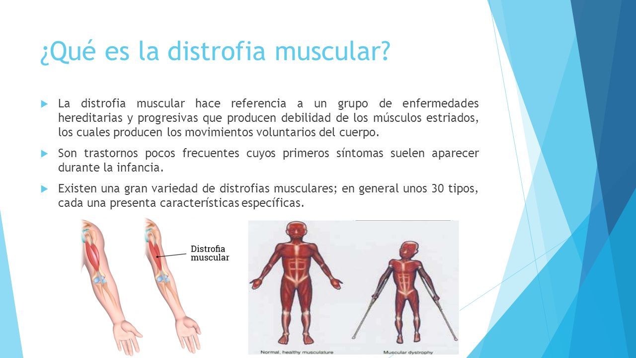 ¿qué Es La Distrofia Muscular La Distrofia Muscular Hace Referencia A